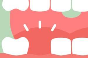 How to handle tooth loss | FastNewSmile® Dental Implant Center