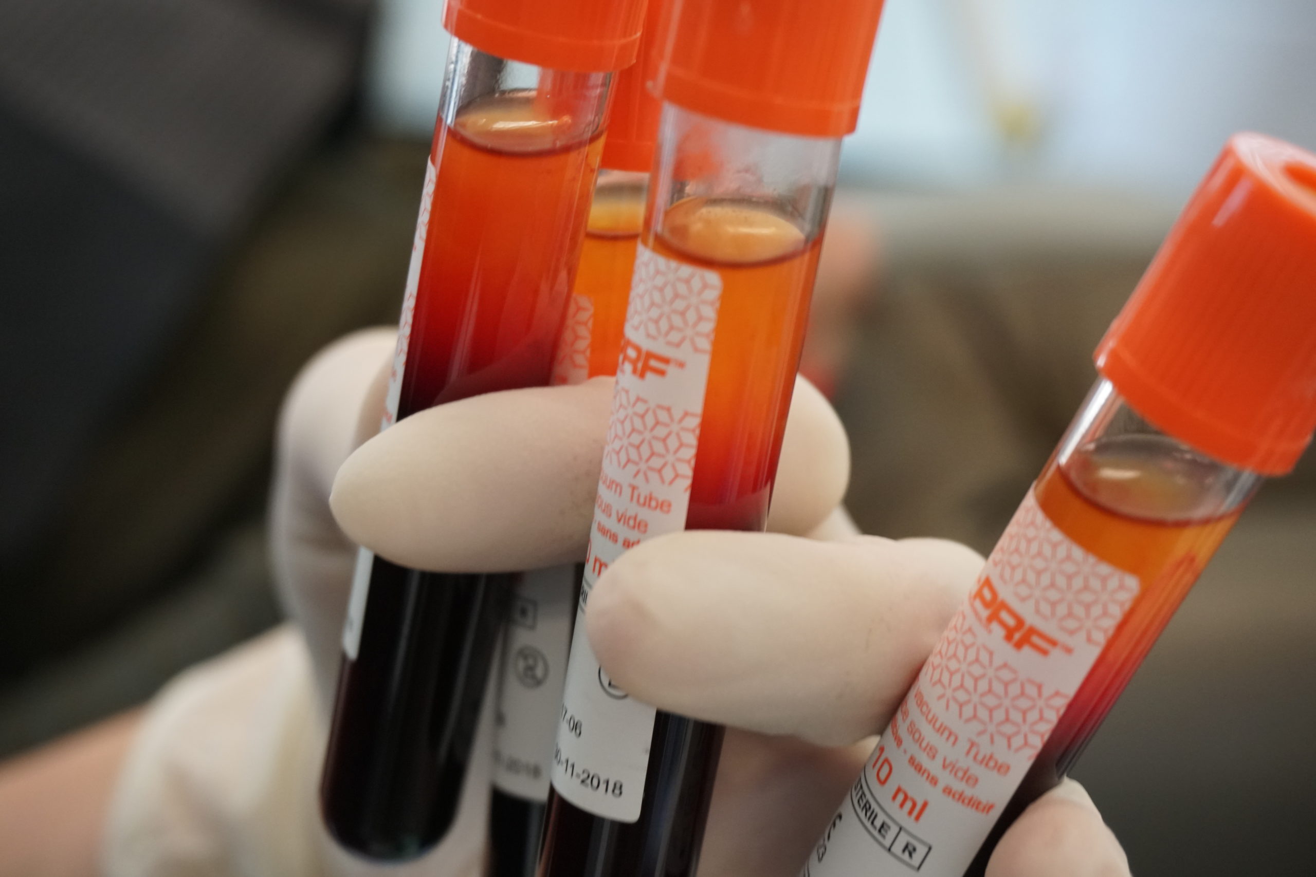 Speed Up Your Dental Implant Healing With PRF | FastNewSmile® Dental ...