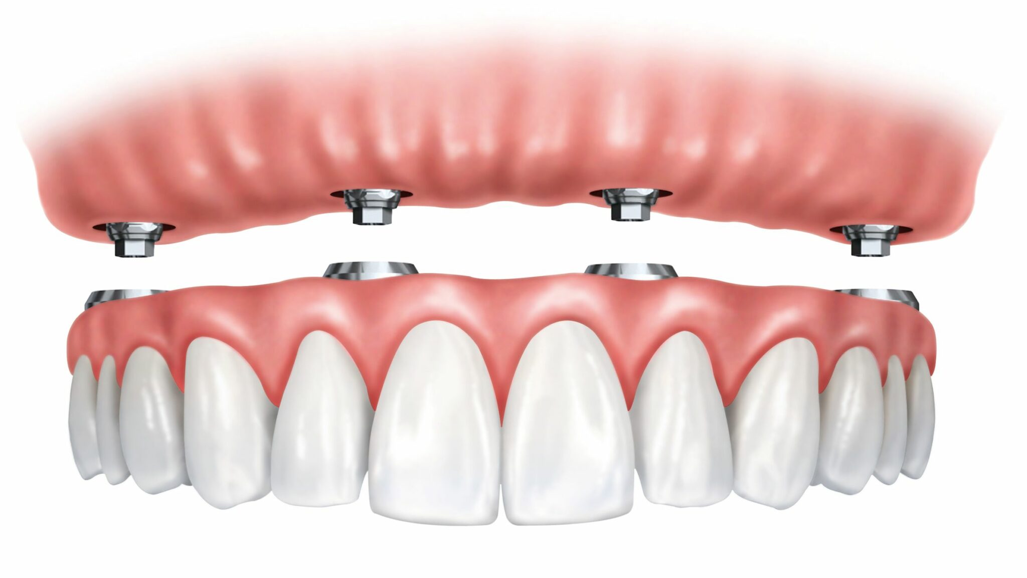 Do You Need Full Arch or Single Dental Implants? | FastNewSmile® Dental ...
